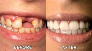 Repairing Tooth Damage Caused by Bulimia