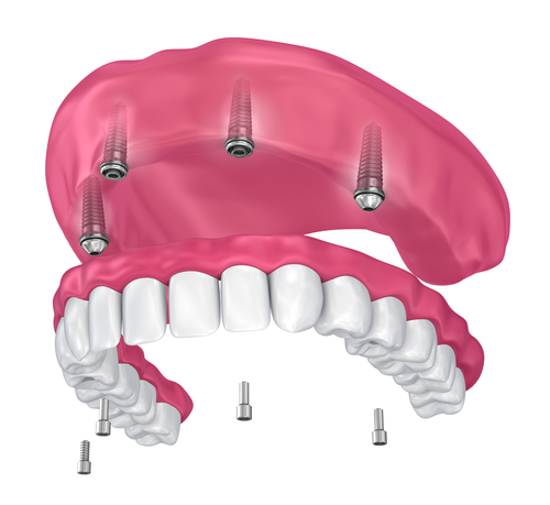 All On Four Implant Anchored Dentures Las Vegas Henderson NV